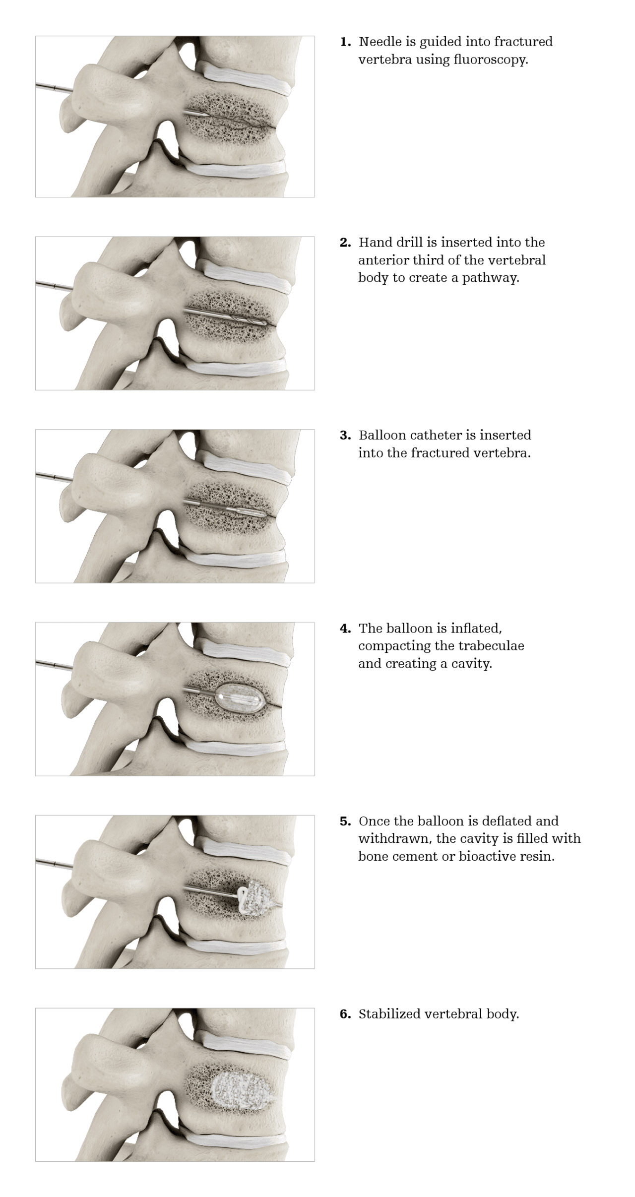 Oregon Spinal Fracture Clinic